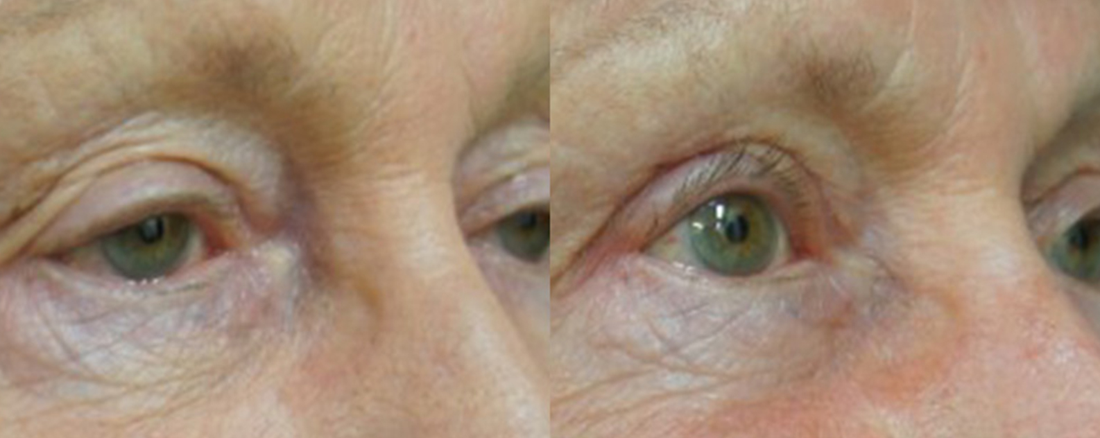Eyelid Surgery Sydney | Blepharoplasty | Form & Face